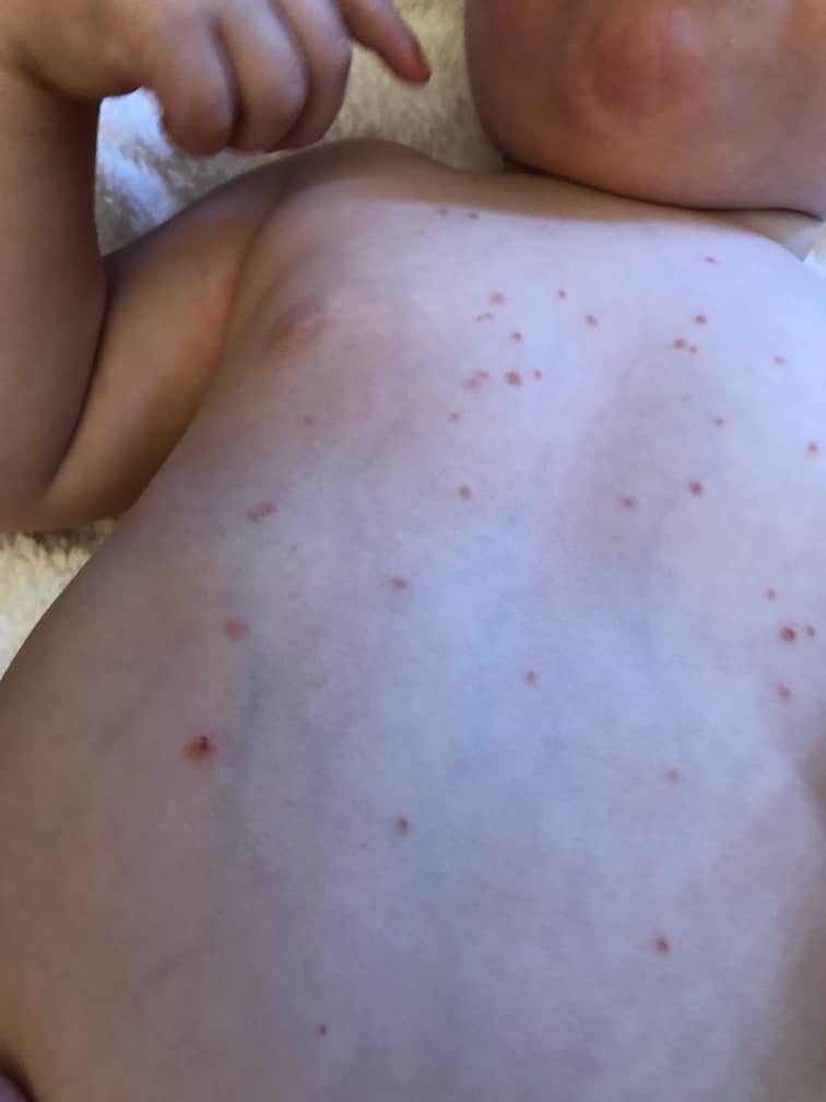 La varicelle : une maladie contagieuse - Journal Le Pays | Tchad